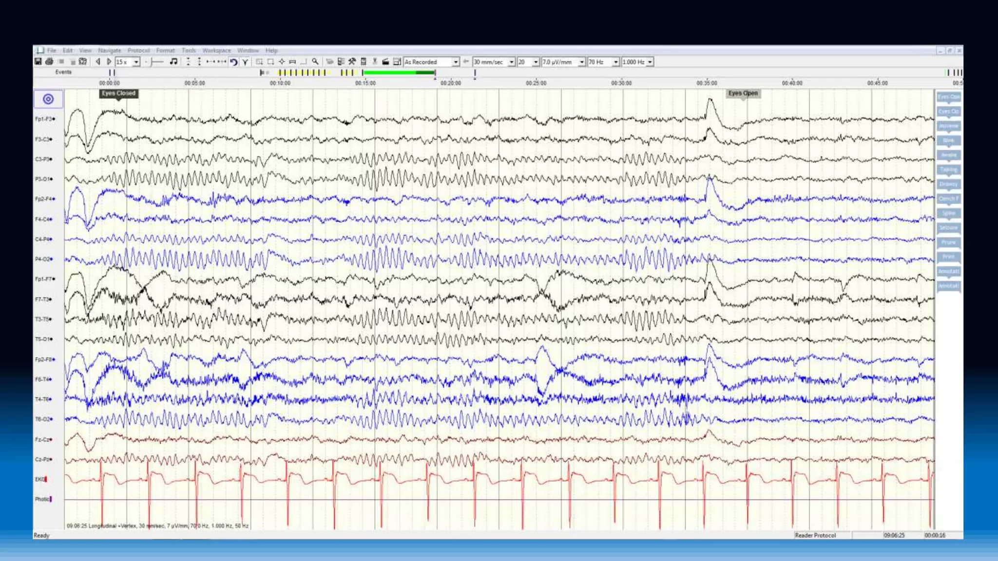 Normal EEG waveforms.pptx | Brain and Nervous System Disorders ...