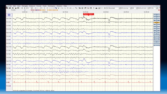 Normal EEG waveforms.pptx | Brain and Nervous System Disorders ...