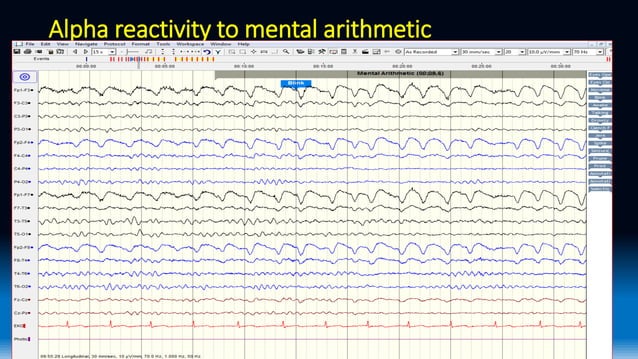 Normal EEG waveforms.pptx | Brain and Nervous System Disorders ...