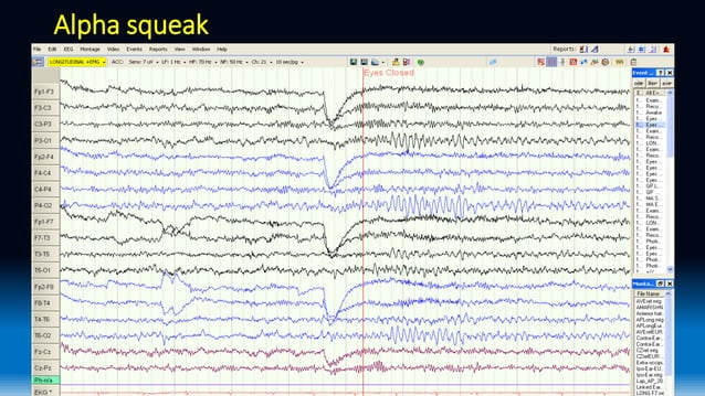 Normal EEG waveforms.pptx | Brain and Nervous System Disorders ...
