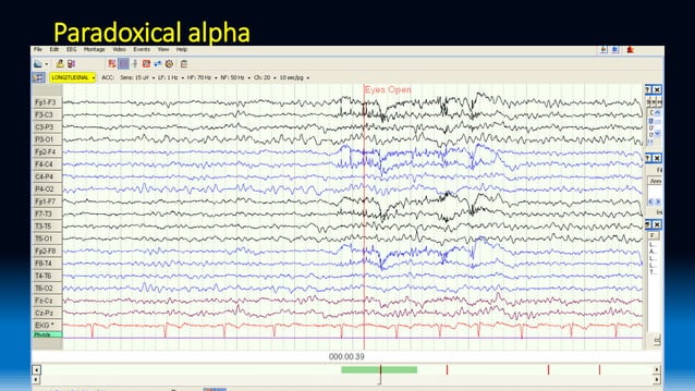 Normal EEG waveforms.pptx | Brain and Nervous System Disorders ...