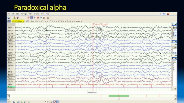 Normal EEG waveforms.pptx | Brain and Nervous System Disorders ...