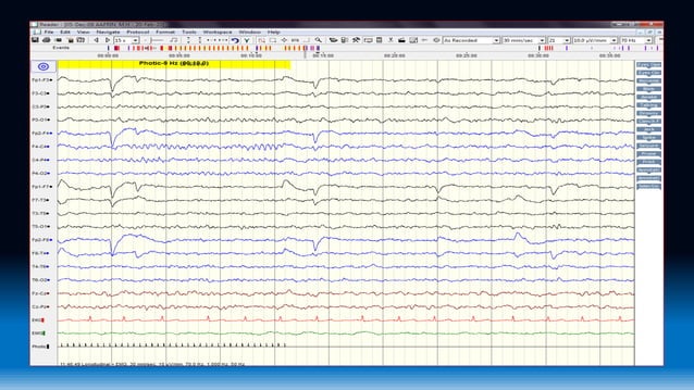 Normal EEG waveforms.pptx | Brain and Nervous System Disorders ...