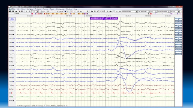 Normal EEG waveforms.pptx | Brain and Nervous System Disorders ...