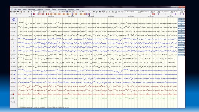 Normal EEG waveforms.pptx | Brain and Nervous System Disorders ...