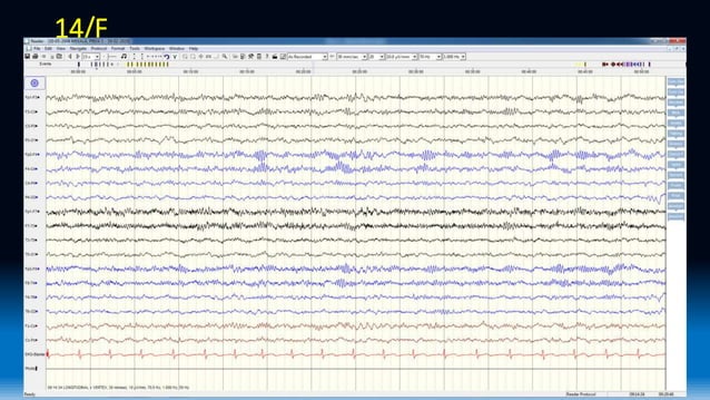 Normal EEG waveforms.pptx | Brain and Nervous System Disorders ...
