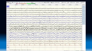 Normal EEG waveforms.pptx
