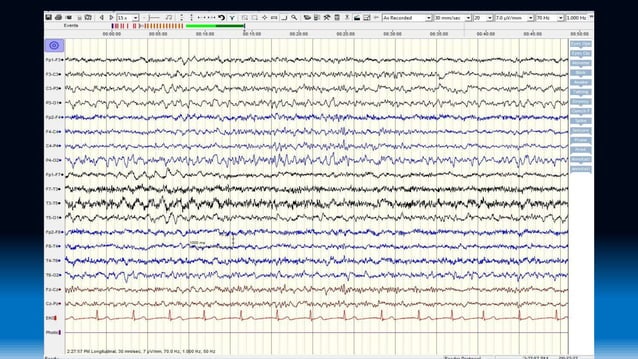 Normal Eeg Waveformspptx Brain And Nervous System Disorders