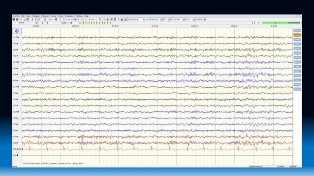 Normal EEG waveforms.pptx | Brain and Nervous System Disorders ...