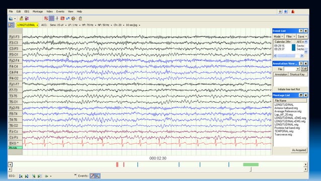 Normal Eeg Waveformspptx Brain And Nervous System Disorders
