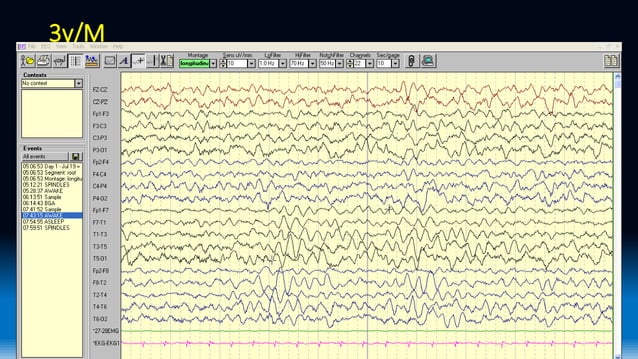 Normal EEG waveforms.pptx | Brain and Nervous System Disorders ...