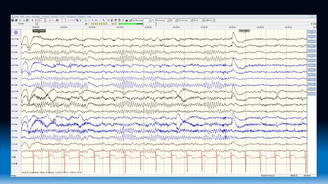 Normal EEG waveforms.pptx | Brain and Nervous System Disorders ...