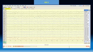 Normal EEG waveforms.pptx