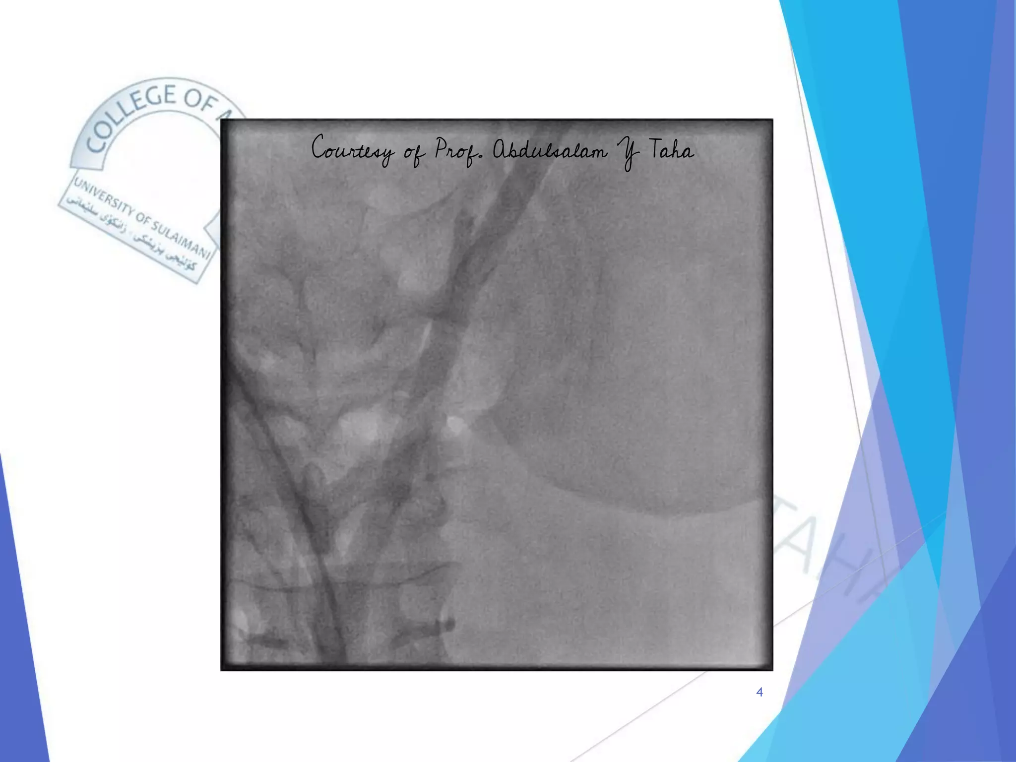 Normal Femoral Arteriogram in a Patient with Fracture femur and ...