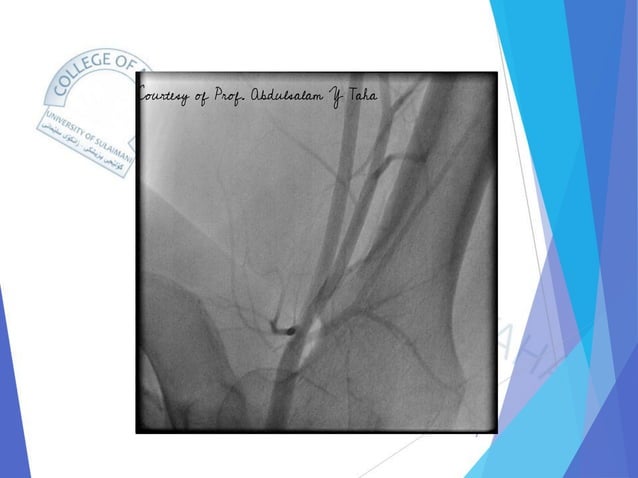Normal Femoral Arteriogram in a Patient with Fracture femur and ...