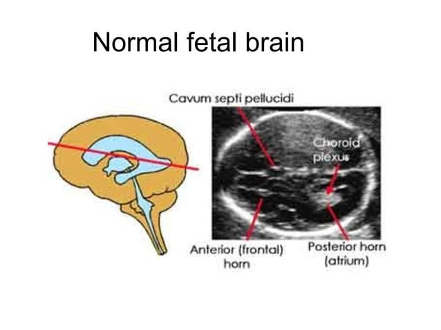 Normal fetal beyin nasildir | PPT