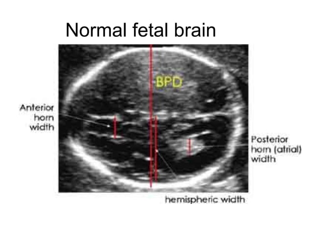 Normal fetal beyin nasildir | PPT