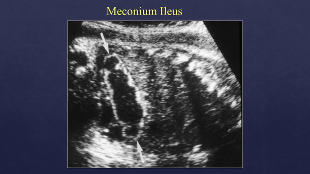 NORMAL FETAL GIT AND ANOMALIES presentation | PPT