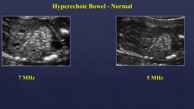 NORMAL FETAL GIT AND ANOMALIES presentation | PPT