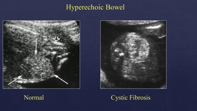 NORMAL FETAL GIT AND ANOMALIES presentation | PPT