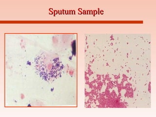 Normal Flora In Sputum