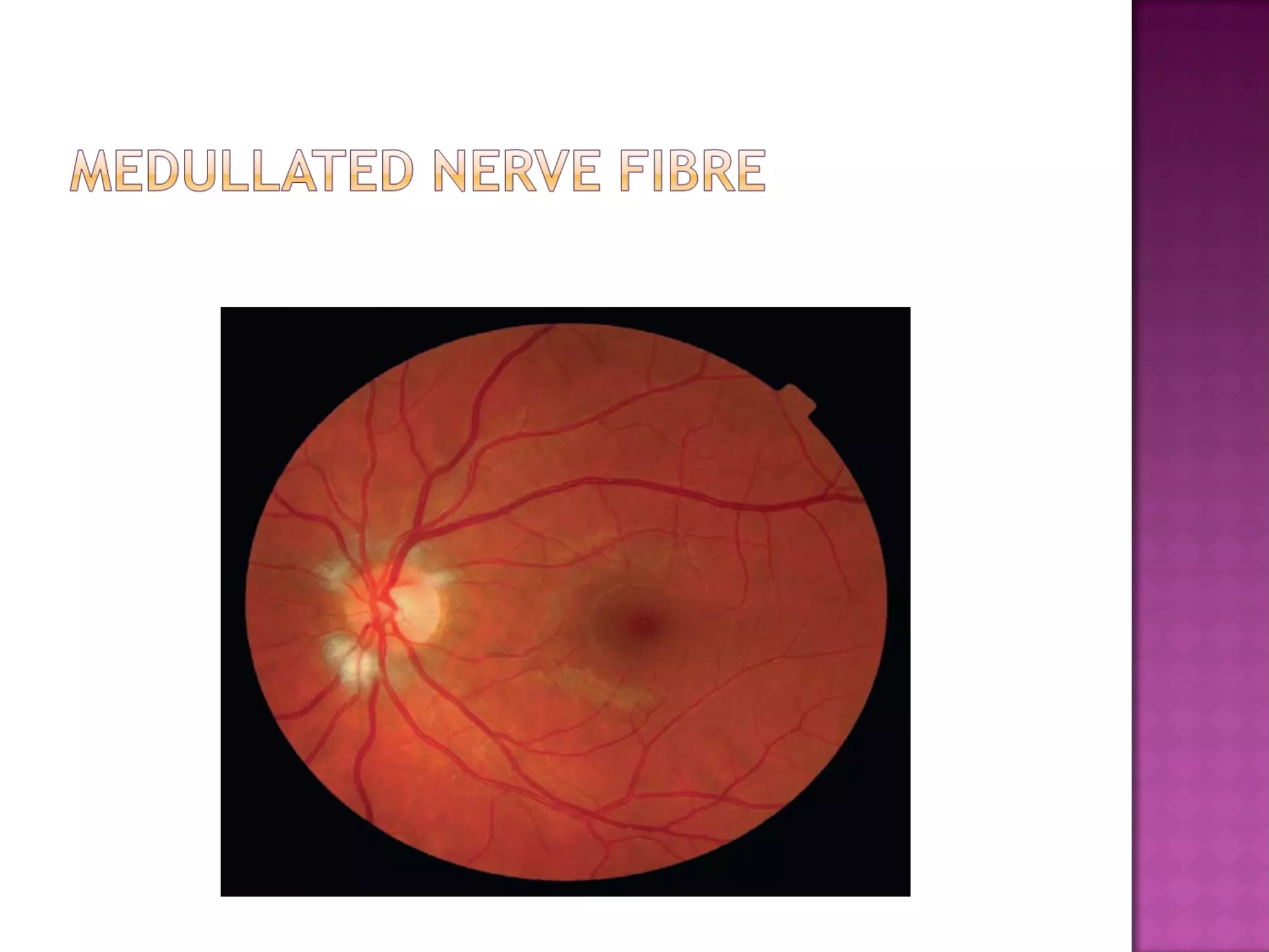 Normal fundus | PPT