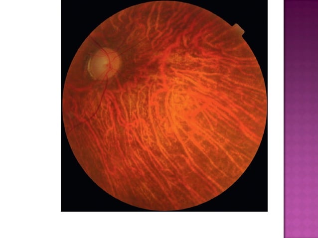 Normal fundus | PPT | Eye and Vision Conditions | Diseases and Conditions
