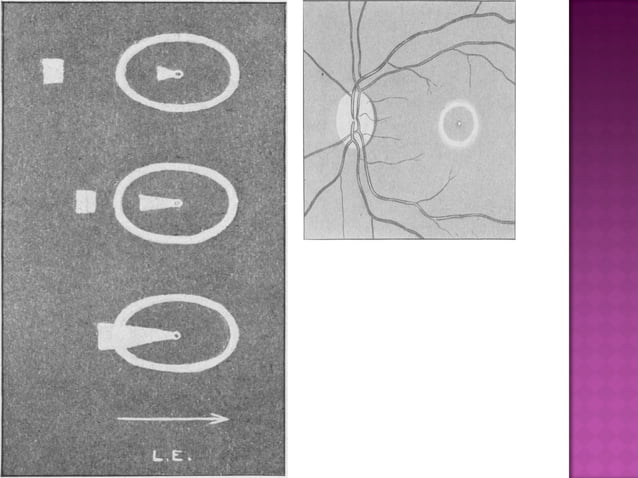 Normal fundus | PPT | Eye and Vision Conditions | Diseases and Conditions