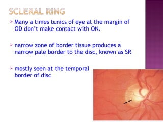 Normal fundus | PPT