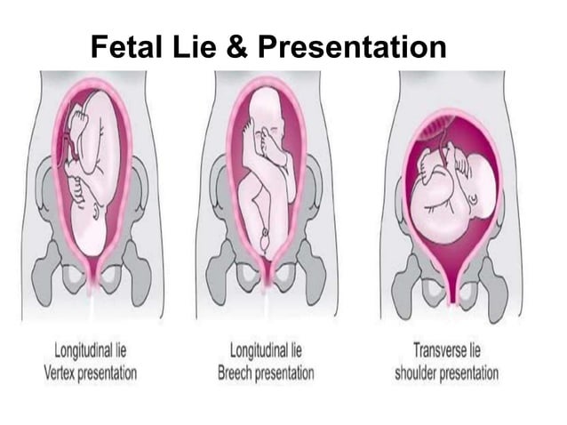 NORMAL LABOUR& Mechanism.pptx