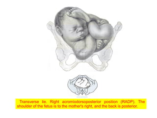 NORMAL LABOUR, MECHANISMS OF LABOUR.pptx