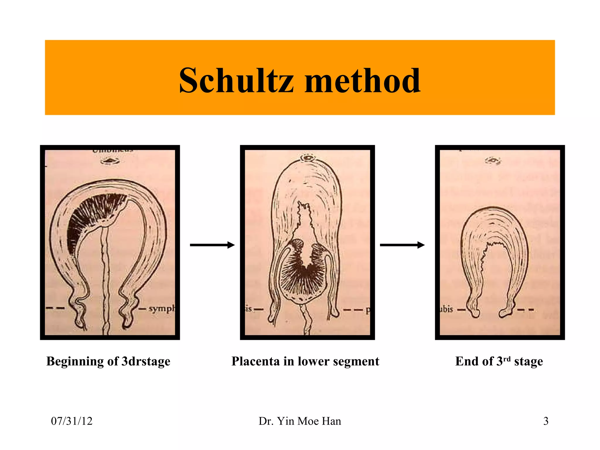 Normal labour, third stage by Dr Yin Moe | PPT