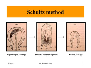 Normal labour, third stage by Dr Yin Moe | PPT