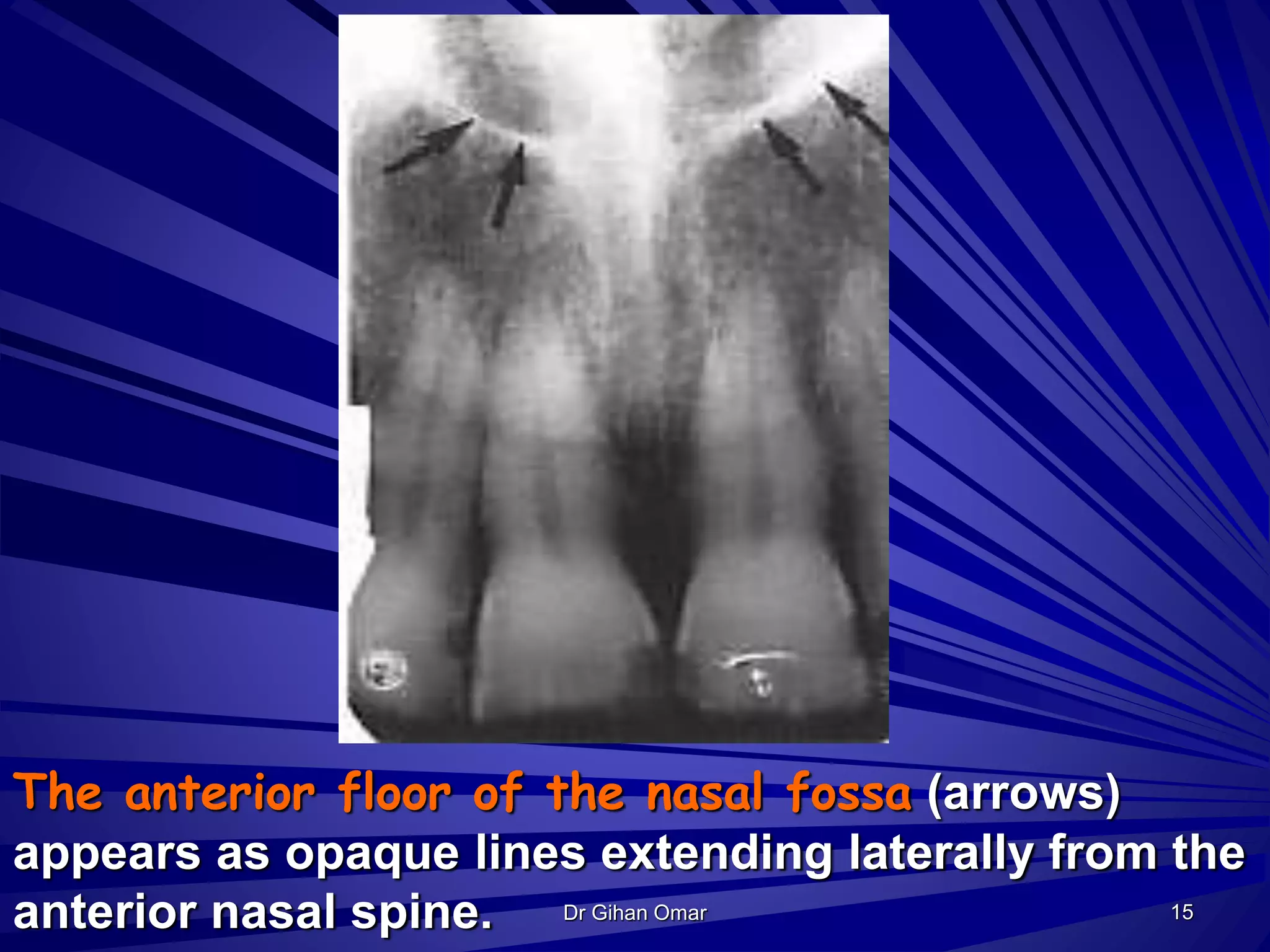 Normal radiographic landmarks | PPTX