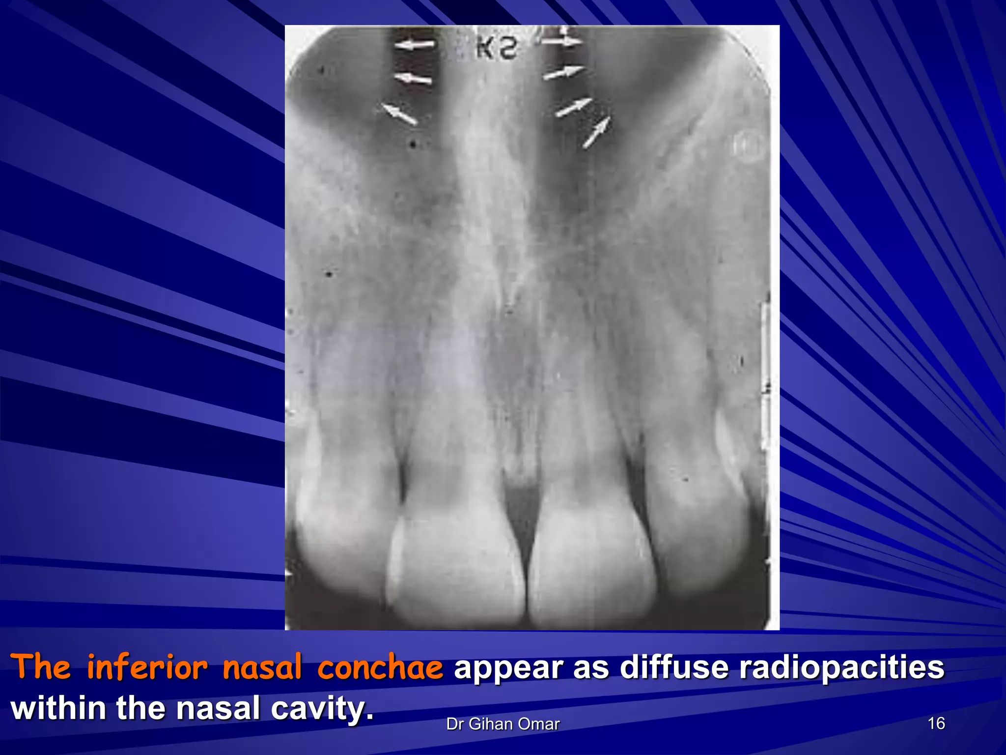 Normal radiographic landmarks | PPTX