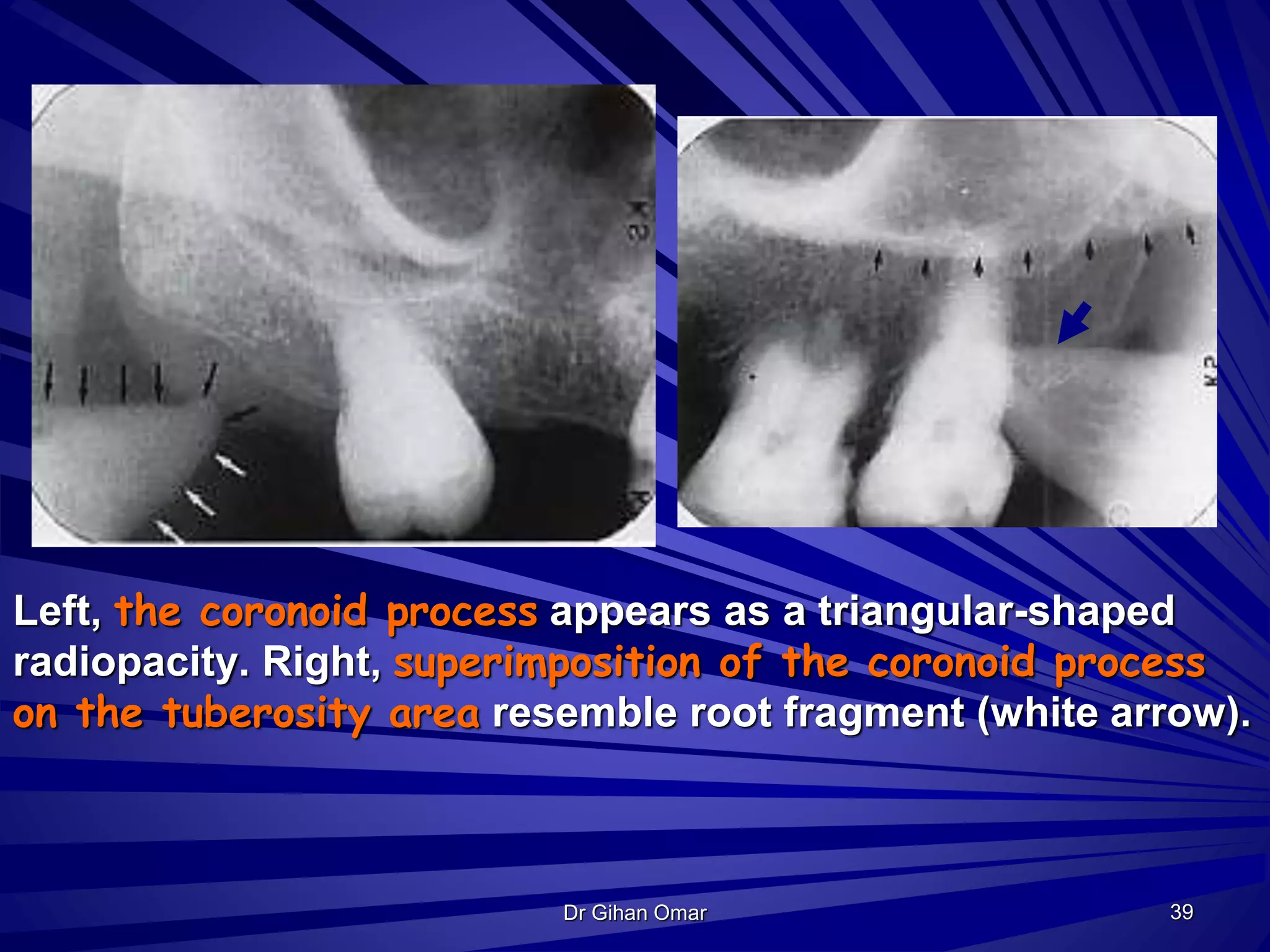 Normal radiographic landmarks | PPTX