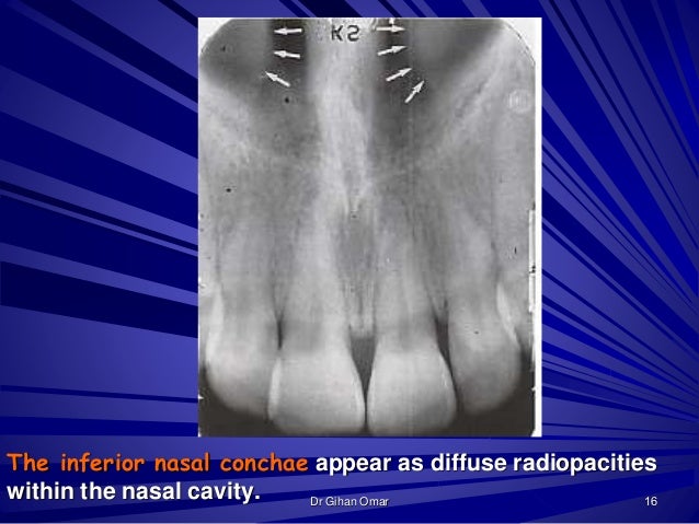 Normal radiographic landmarks