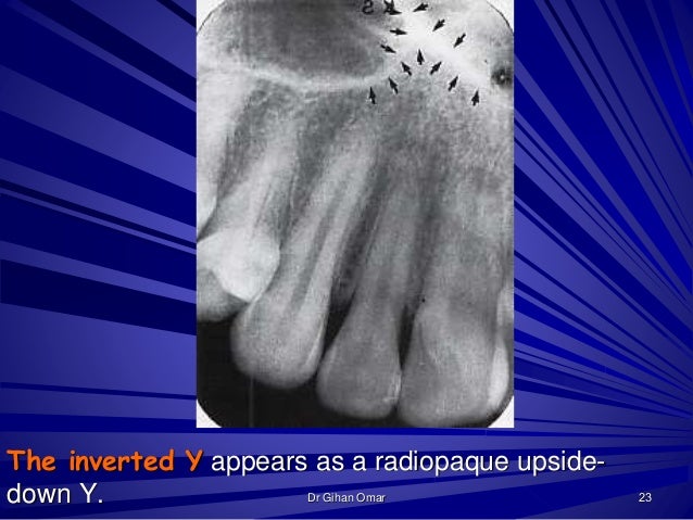Normal radiographic landmarks