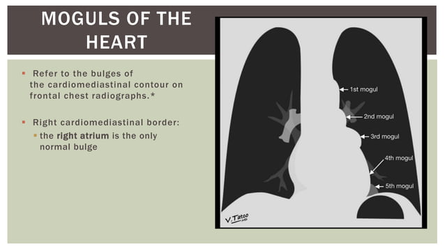 Normal mediastinum radiograph | PPT