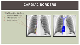 Normal mediastinum radiograph | PPTX