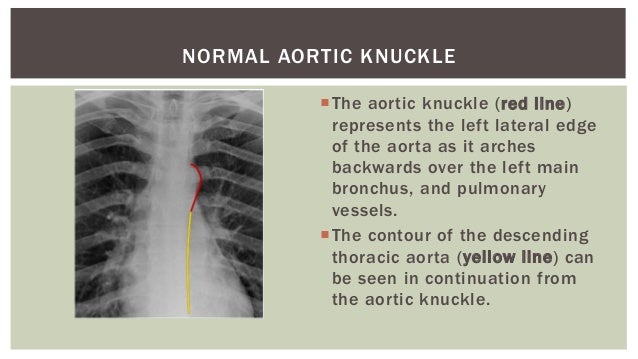 Normal mediastinum radiograph