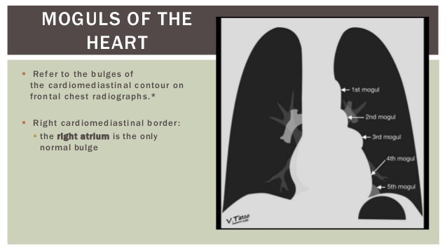 Normal mediastinum radiograph