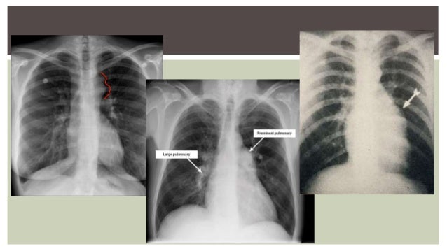 Normal mediastinum radiograph