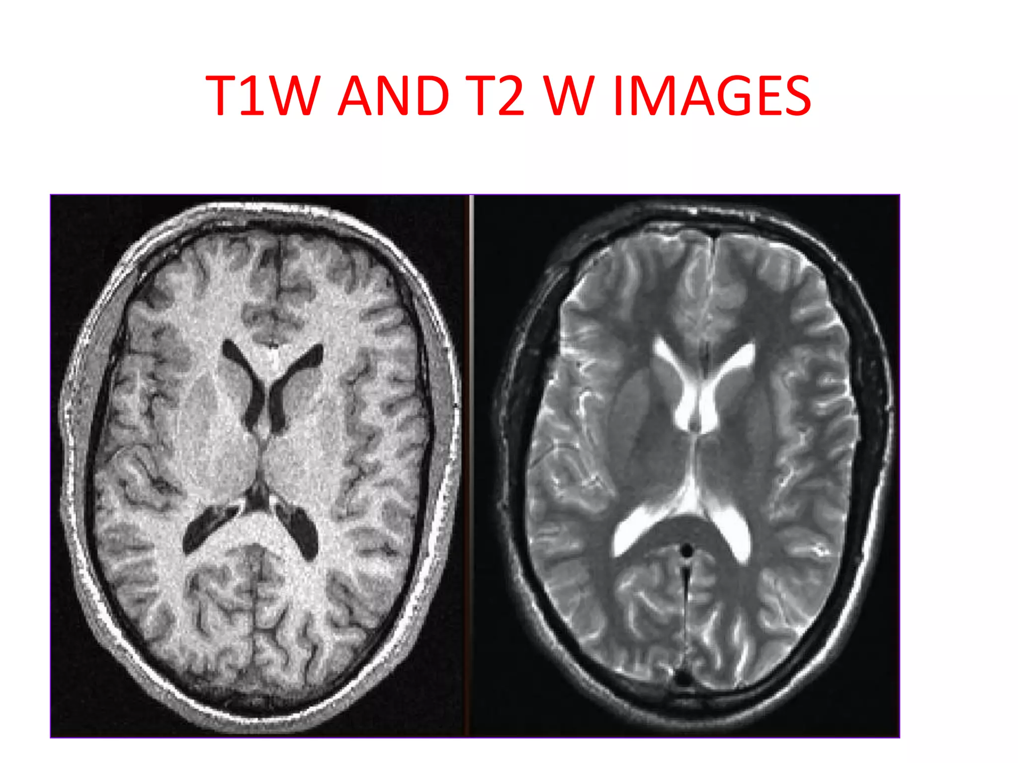 Normal mri brain | PPTX