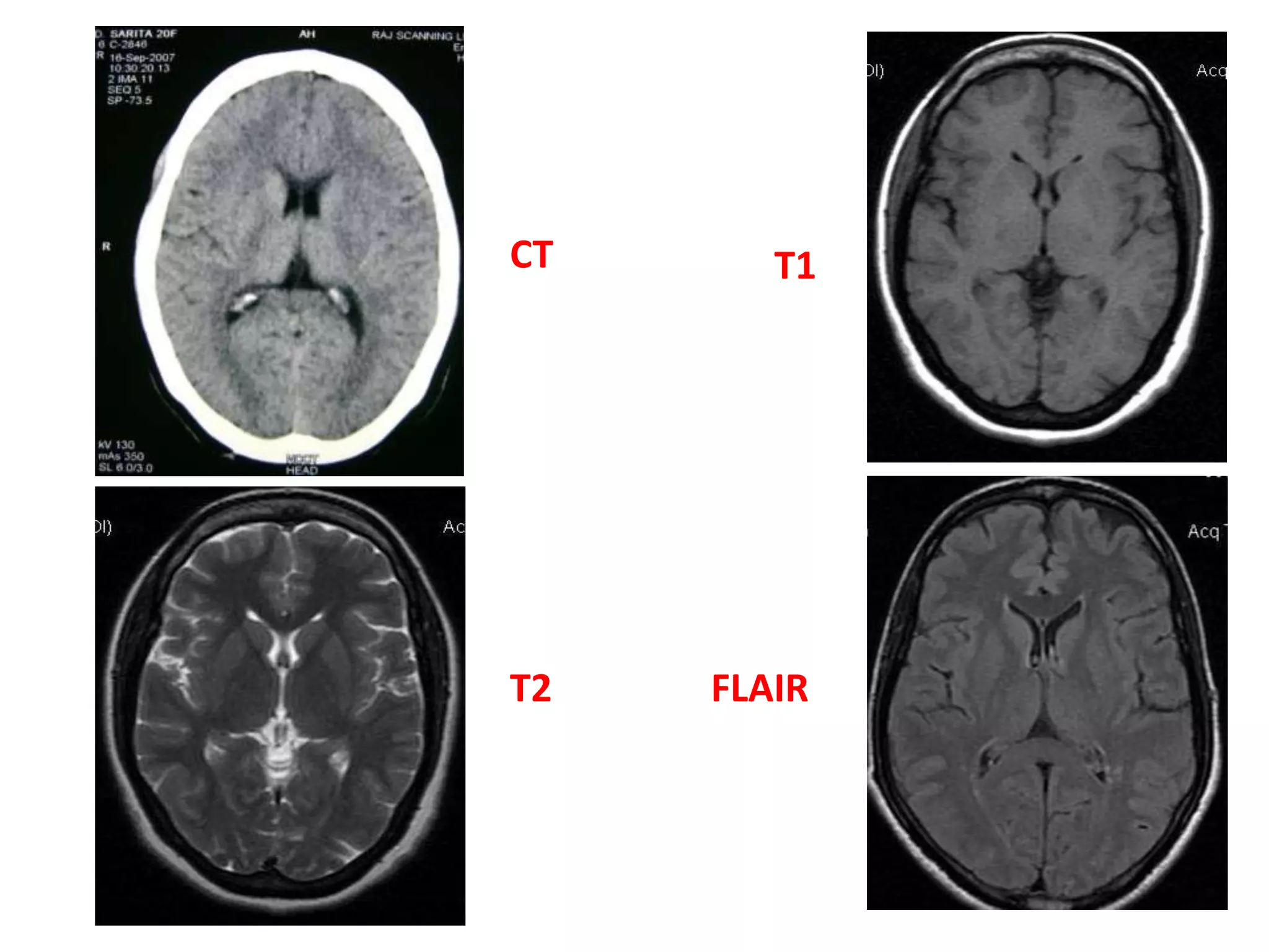 Normal mri brain | PPTX