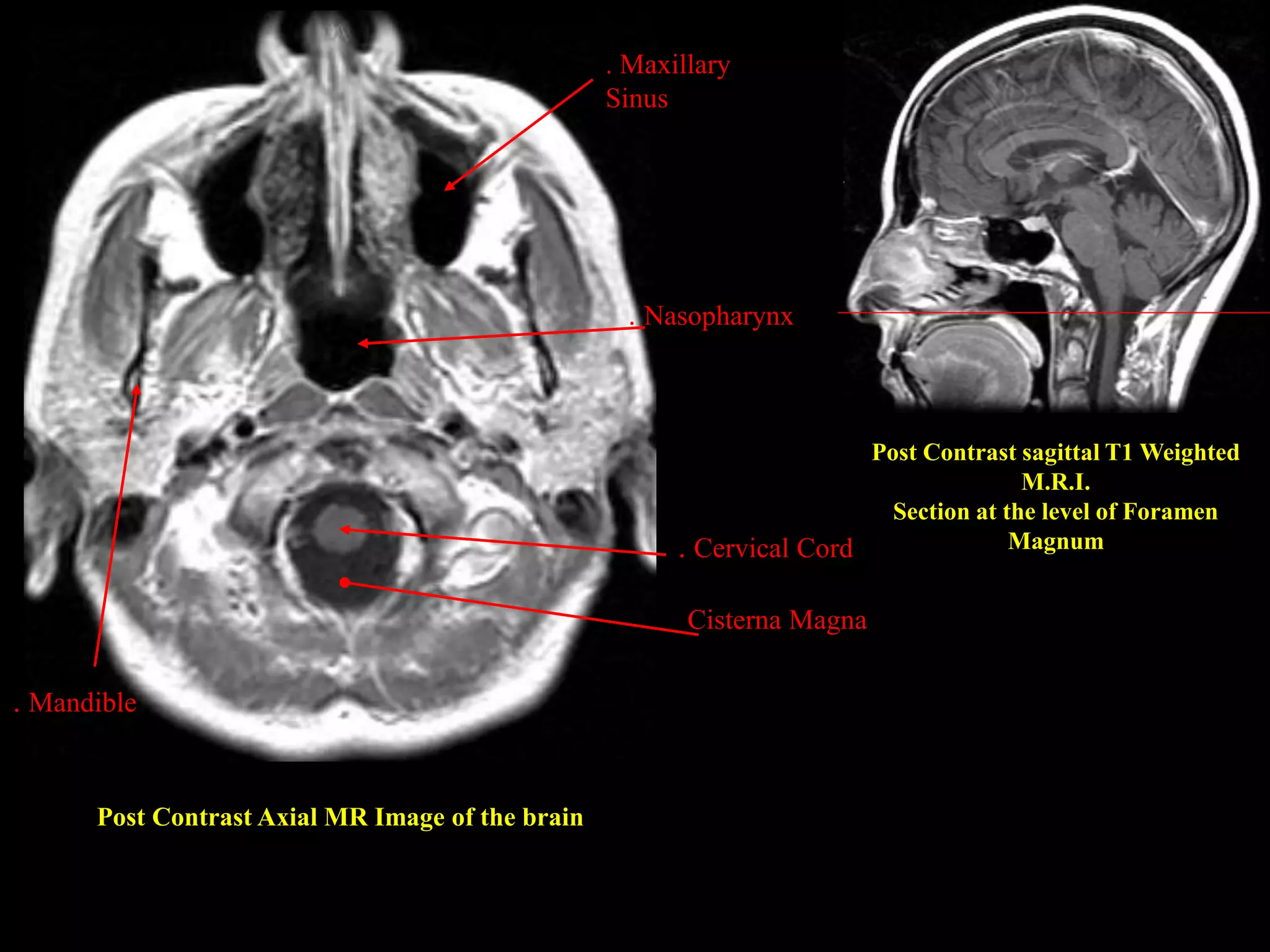 Normal mri brain | PPTX