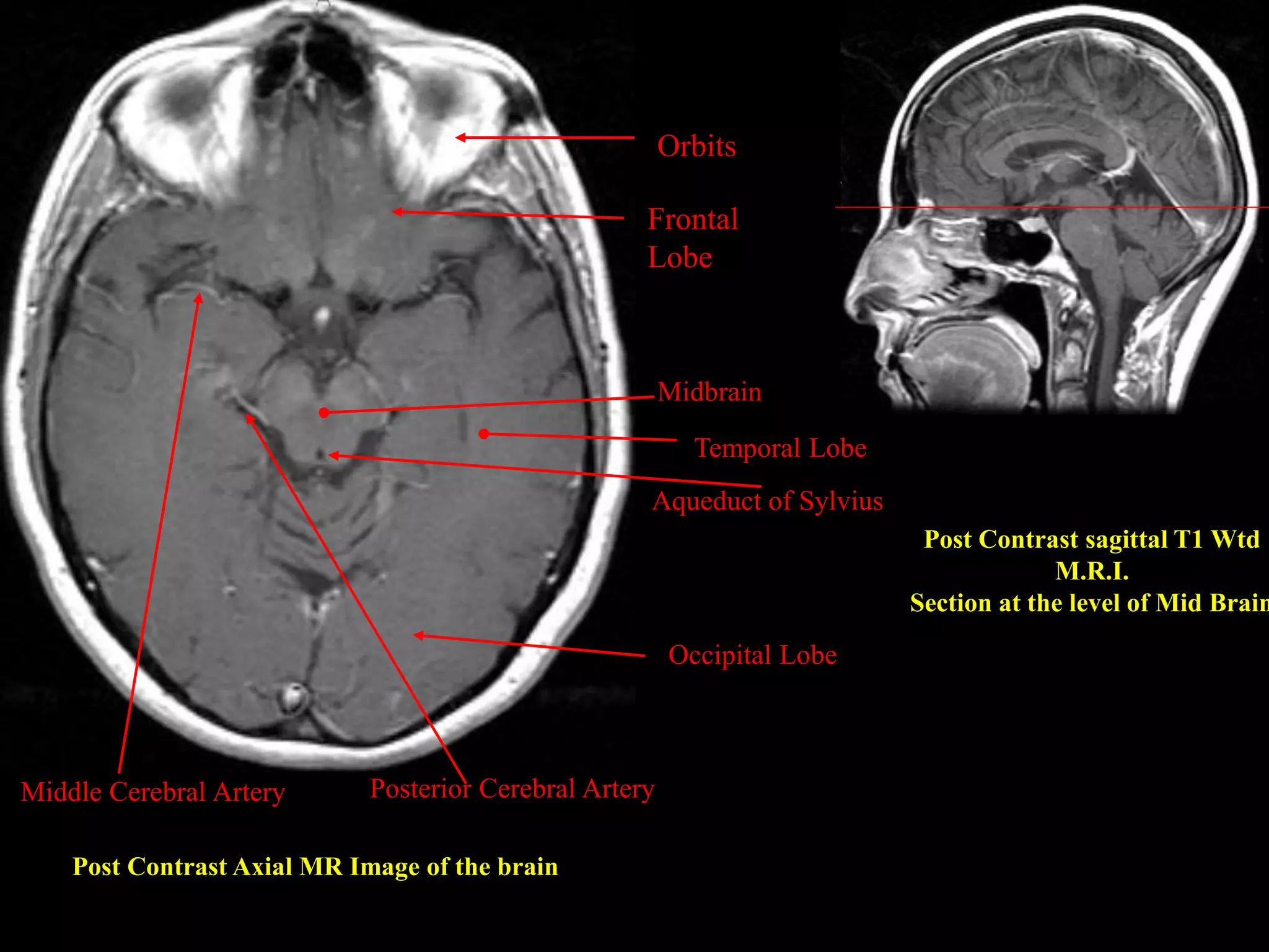 Normal mri brain | PPTX