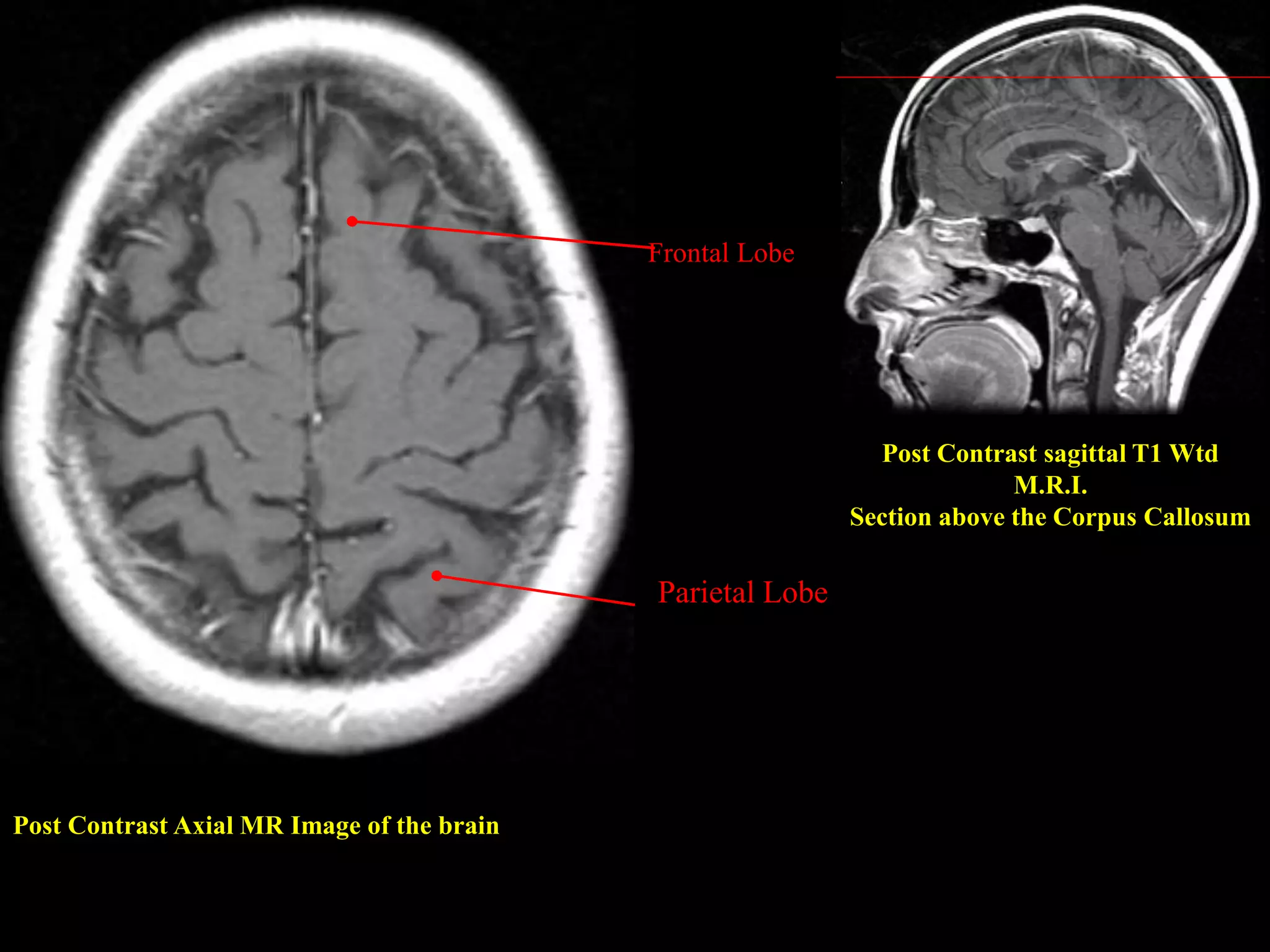 Normal mri brain | PPTX