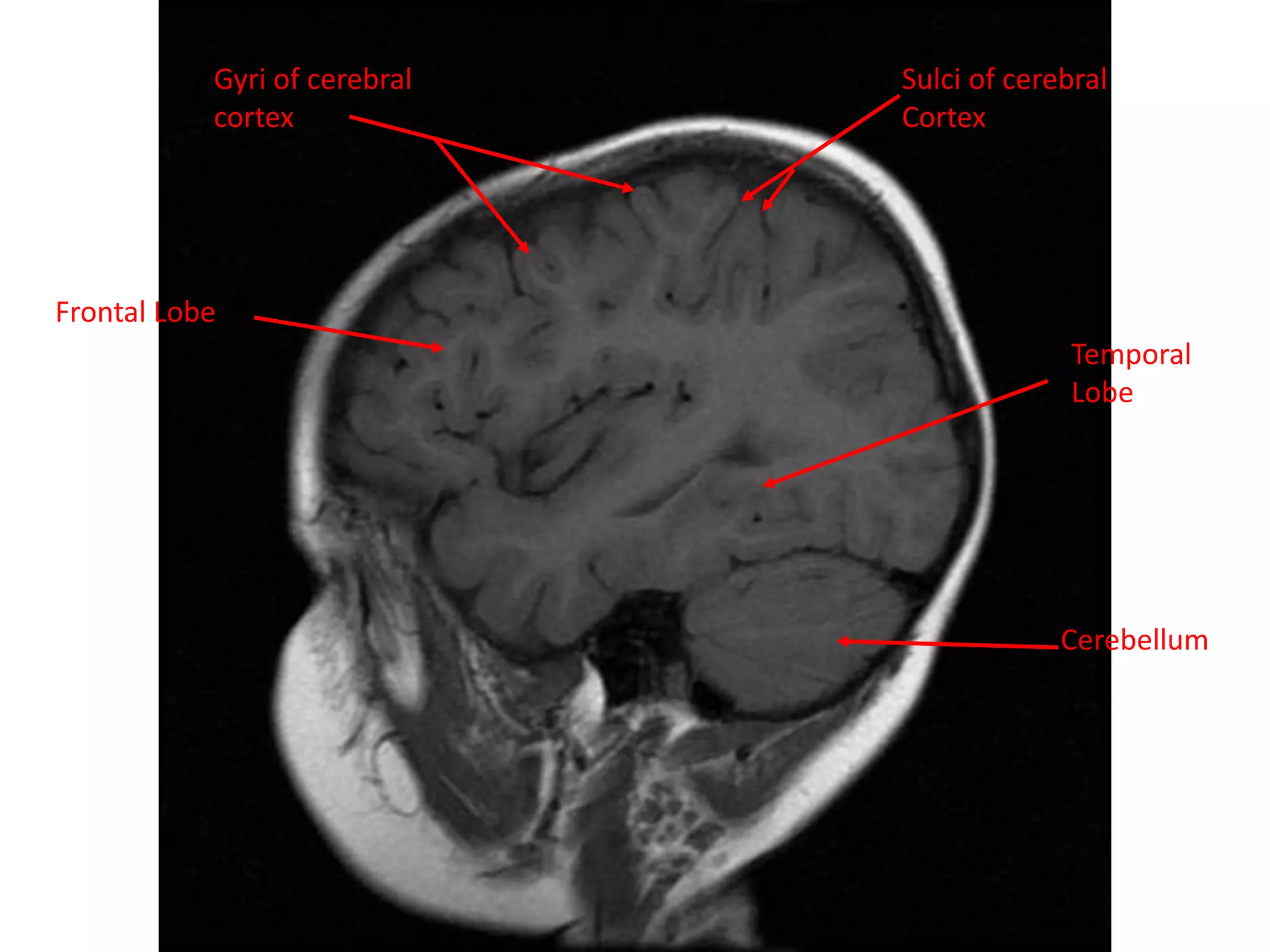 Normal mri brain | PPTX