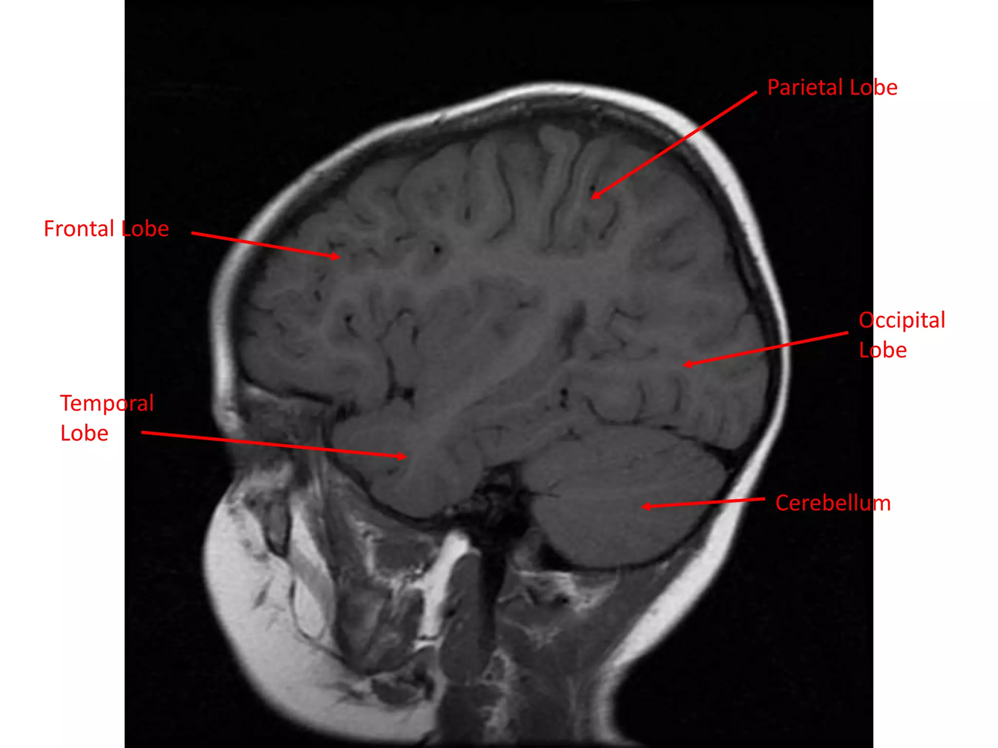 Normal mri brain | PPTX